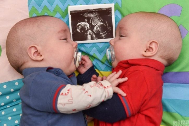 Identical Twins Cheat Death In The Womb By Hugging Each Other ...