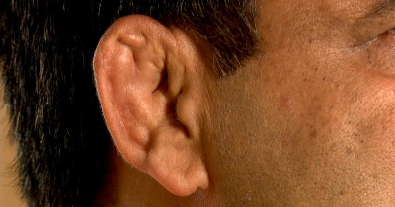 Have You Ever Wondered Why Wrestlers Have Disfigured Ears?