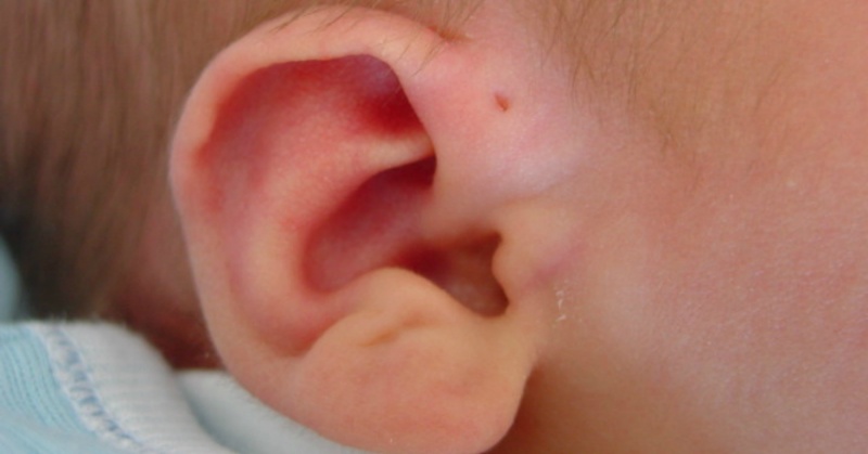 Ear Pit: Why Some People Have That Tiny Extra Hole In Their Ear ...