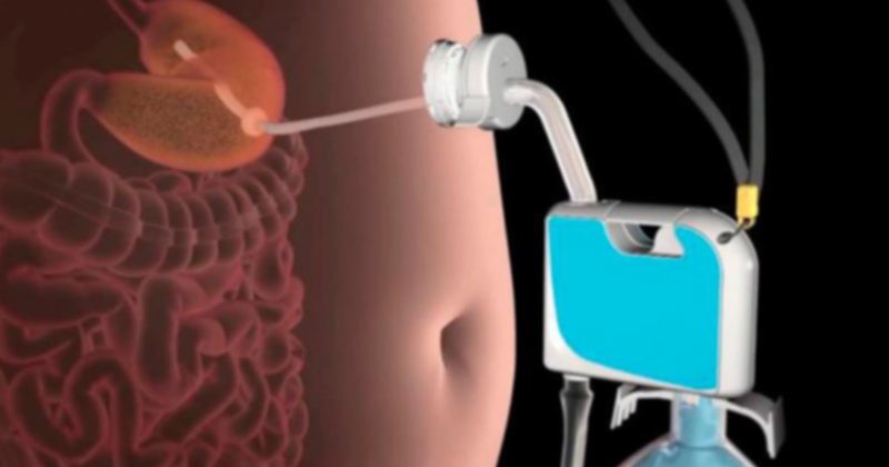 This New Technology Allows You To Pump Food Out Of Your Stomach To Lose ...