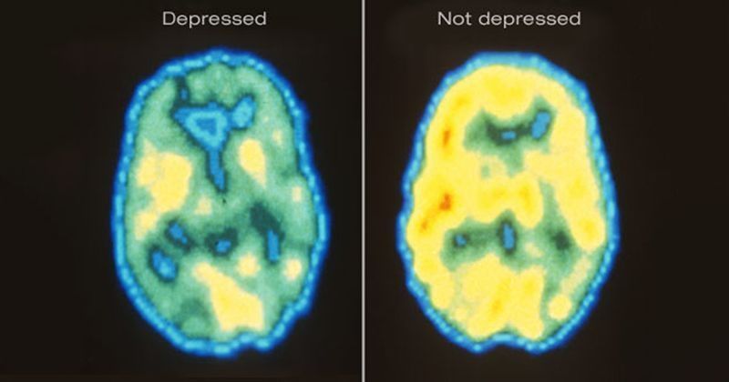 Ever Wondered What Causes Depression In Your Brain? There’s A Pattern ...