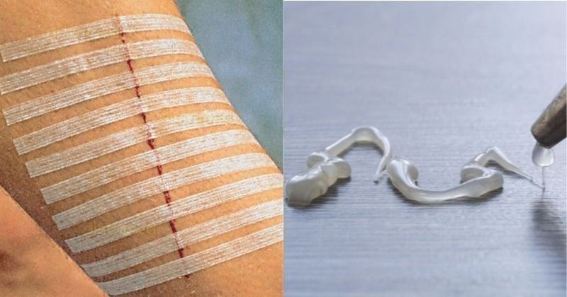 bioglue:This Bio-Glue Can Stop Bleeding In A Wound In Just 20 Seconds ...
